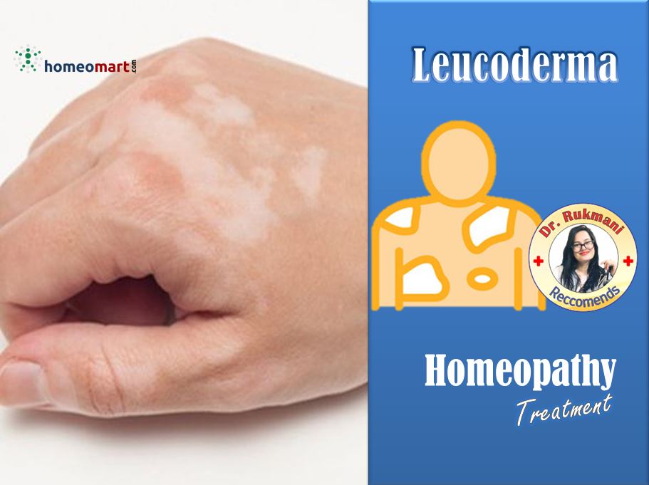 Top Homeopathy Medicine List for Vitiligo Treatment. Buy Online
