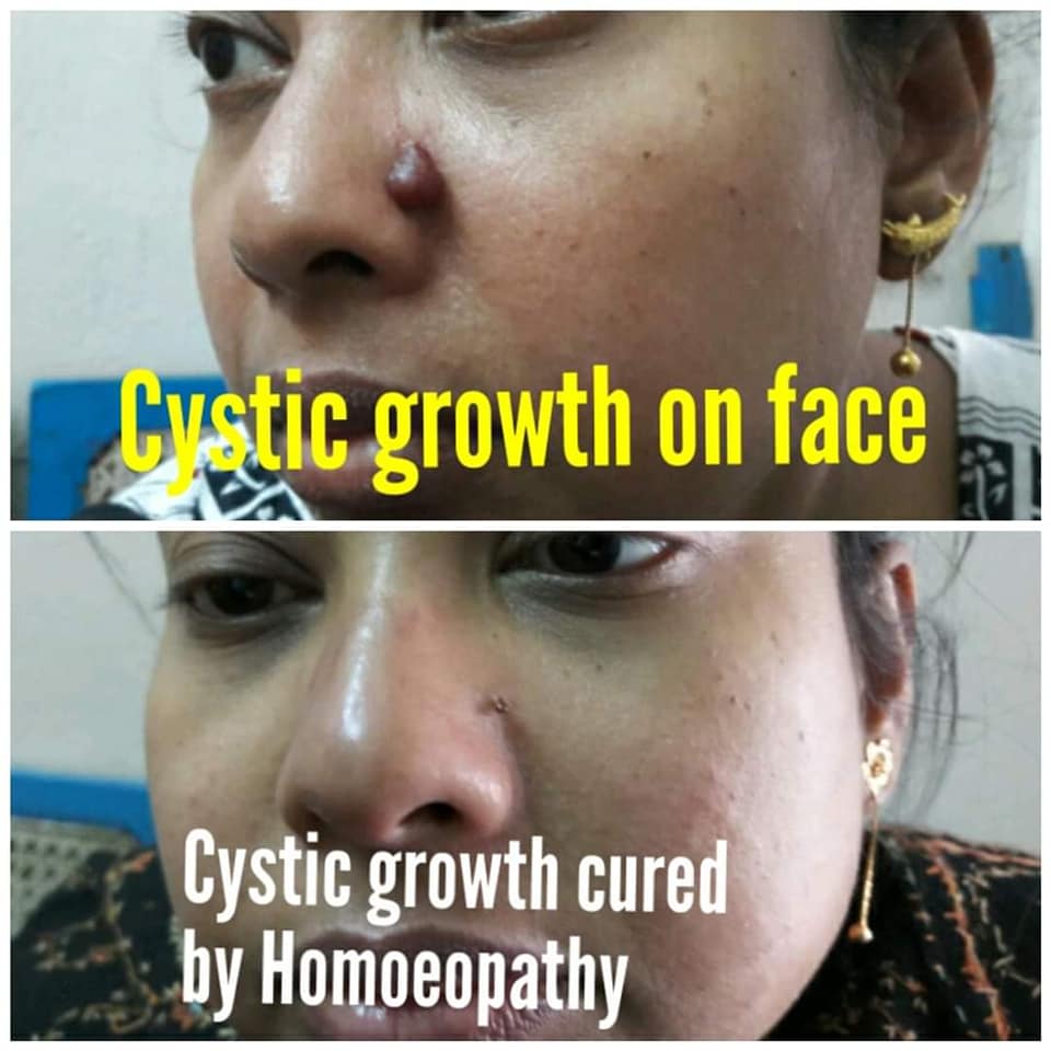 How to remove skin growth on face with natural remedies