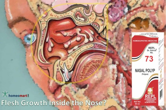 Treatment Options for Flesh Growth Inside the Nose: A Guide