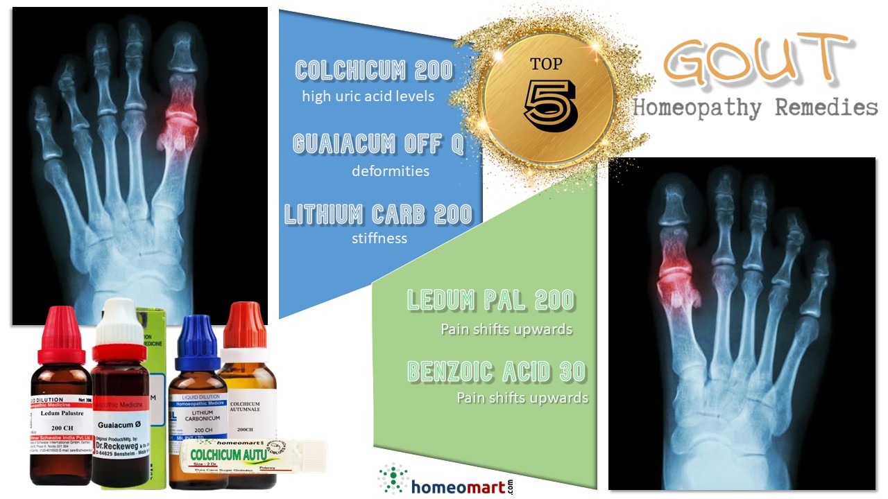 Uric acid treatment at home. Gout relief homeopathy medicines ...