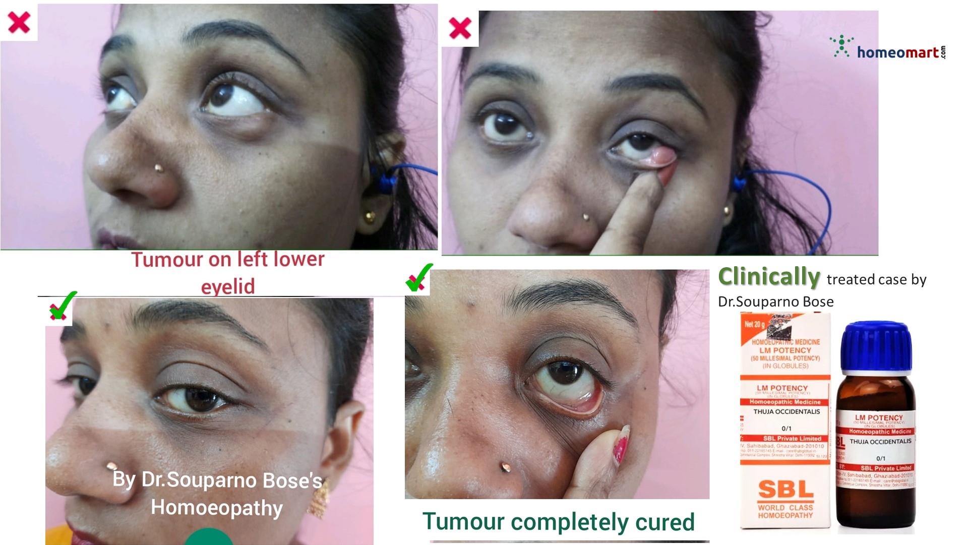 Tumor in eye symptoms and treatment. Clinically cured case study ...