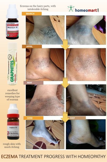 Graphites for Eczema Relief | Homeopathy for Dry, Itchy Skin